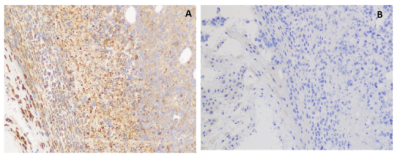 2023 ASH|盘点GPRC5D靶点生物药临床研究进展 - 专注肿瘤免疫